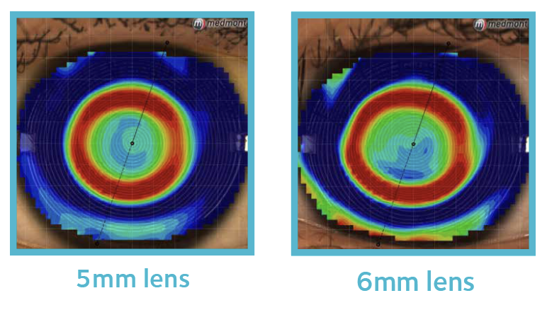 5MM OZD Lens Customization
